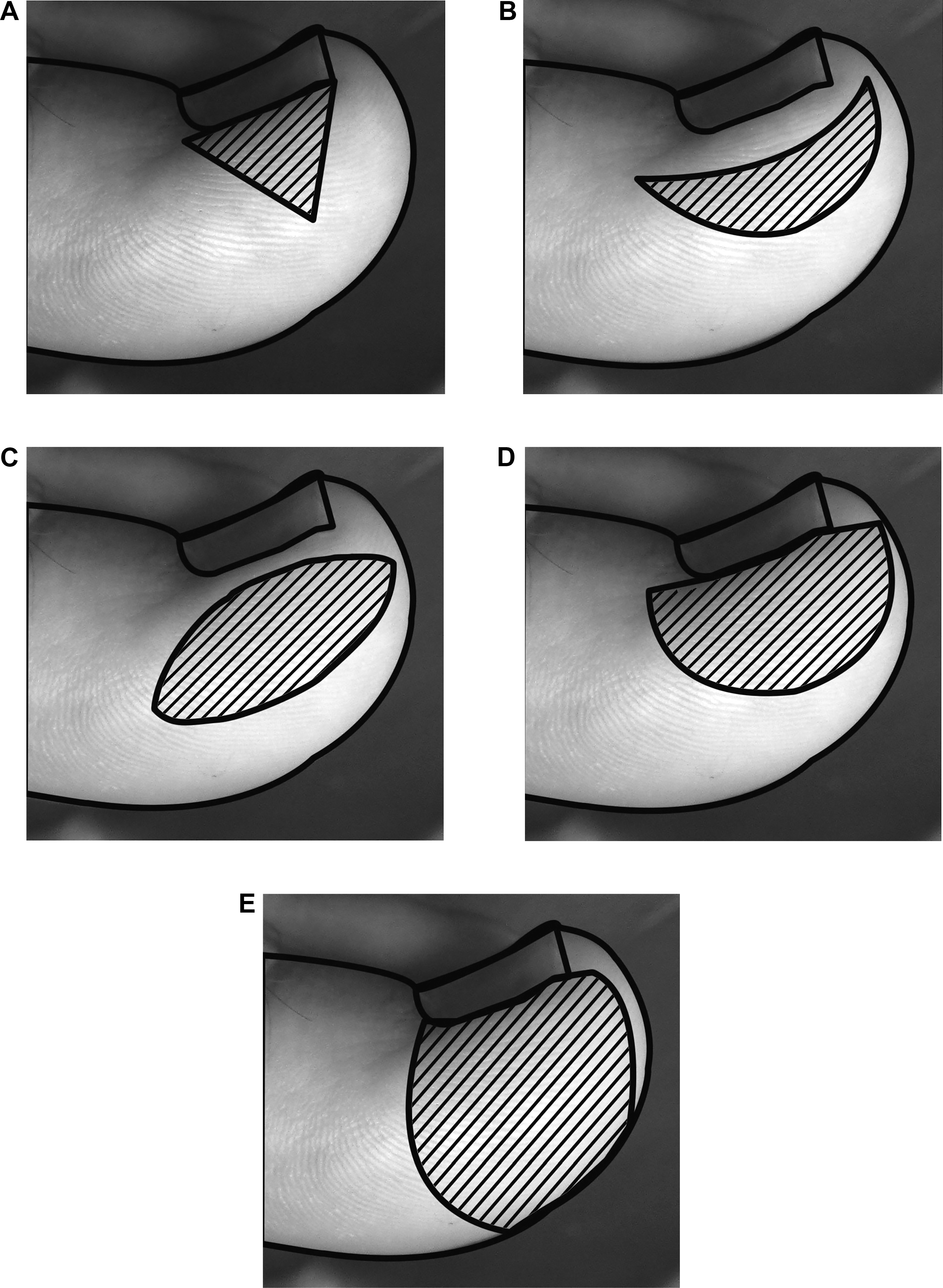 Operative Treatment of Ingrown Toenail by Nail Fold Resection Without ...