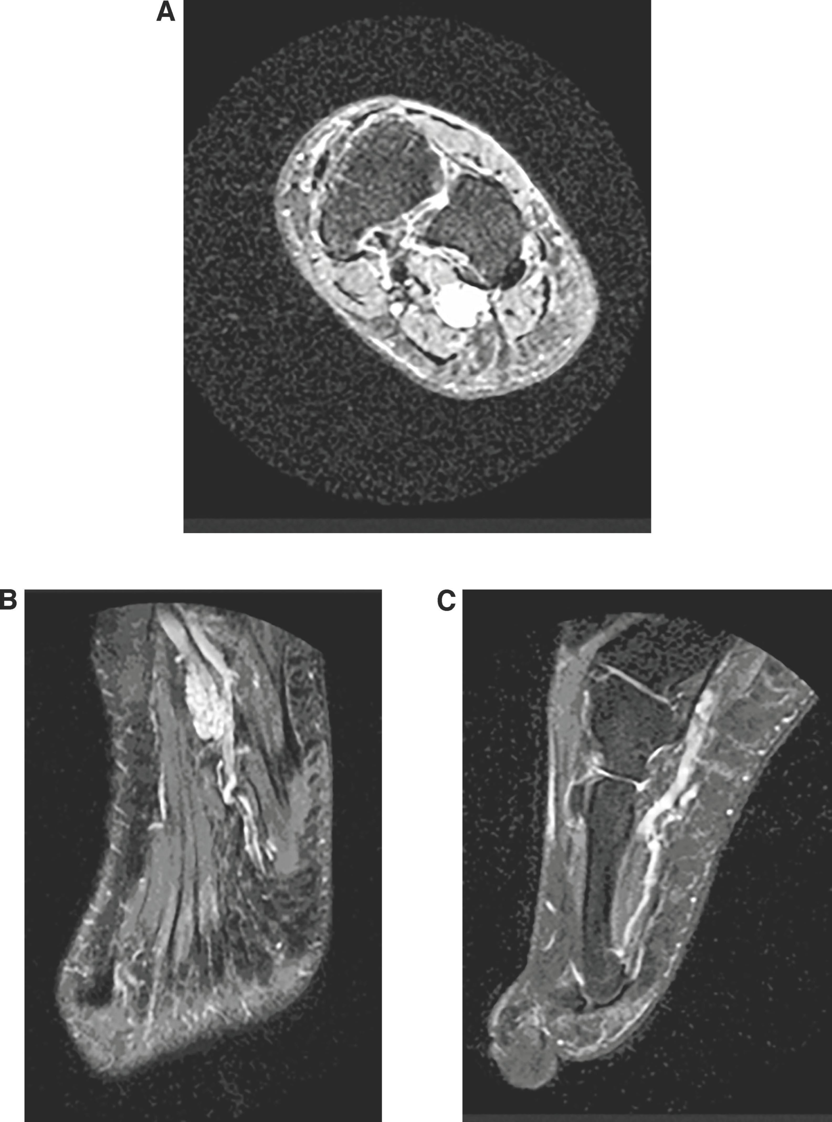 A Nonsurgical Approach to Arteriovenous Malformation of the Foot. A ...