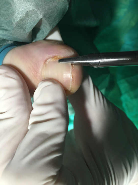 Onychoplasty with 1064-nm Laser: Matrixectomy for Treatment of Ingrown ...