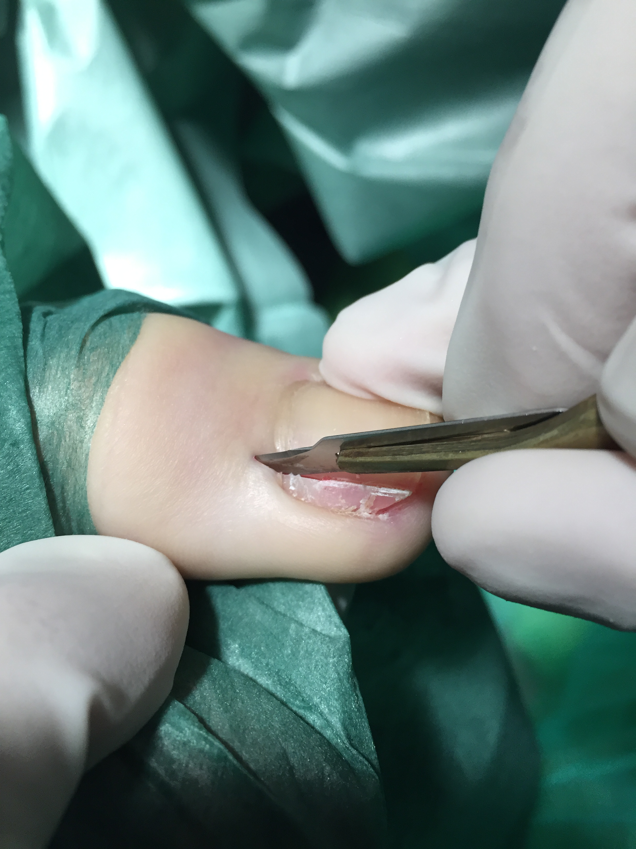 Onychoplasty with 1064-nm Laser: Matrixectomy for Treatment of Ingrown ...