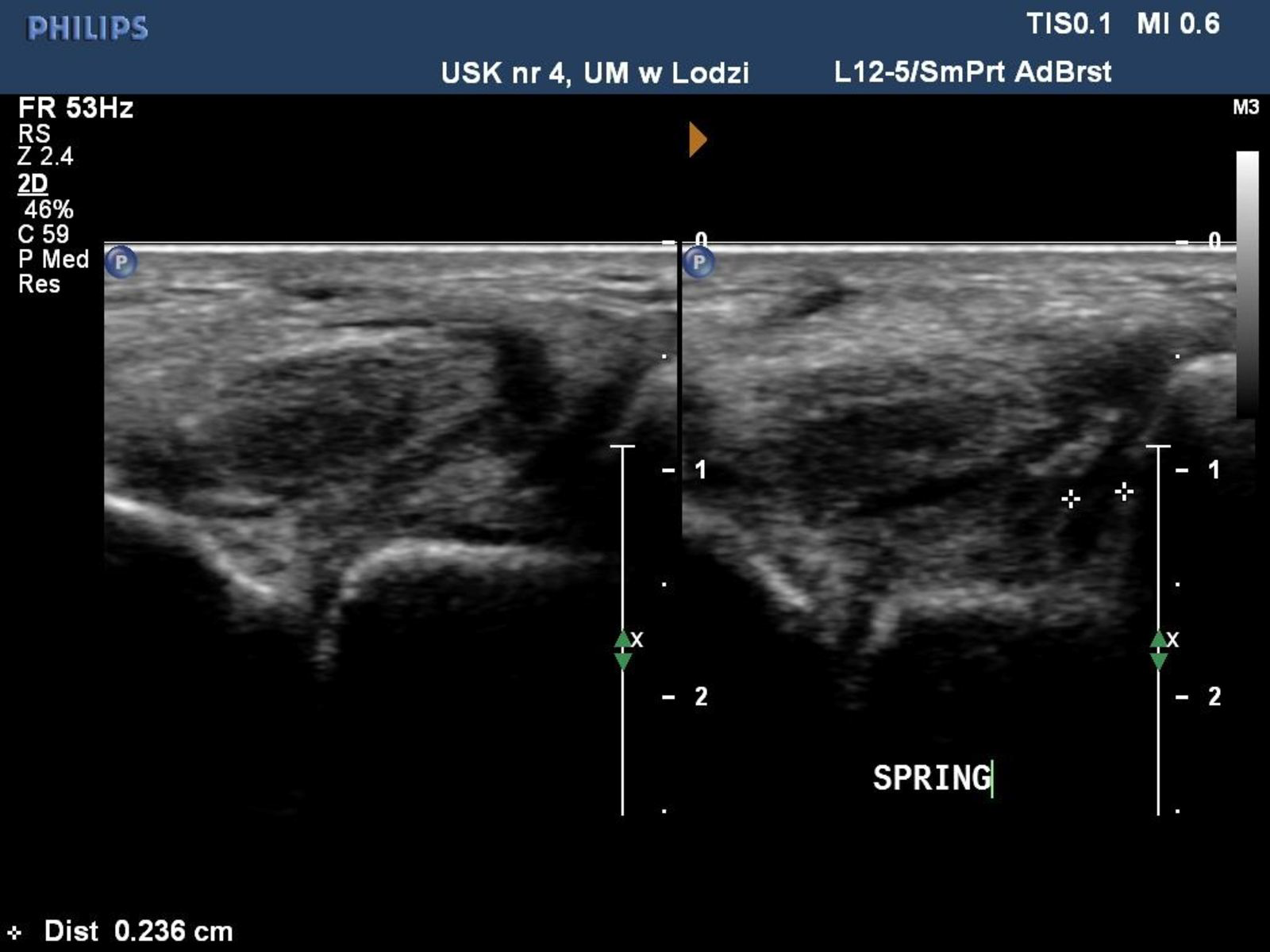Morphology of Spring Ligament Fibrocartilage Complex Lesions