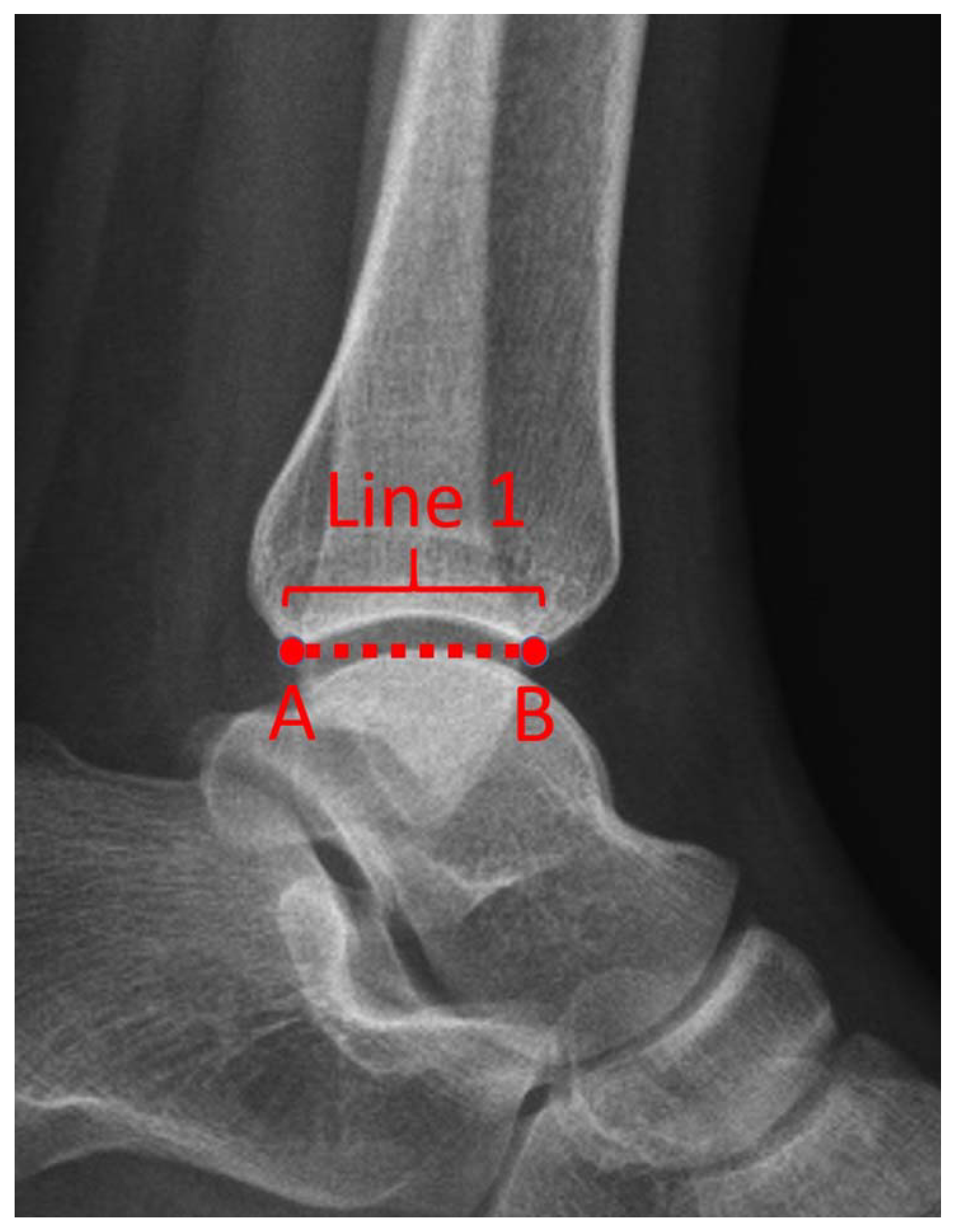 A New Reference to Evaluate Syndesmosis in Sagittal Plane Radiographs ...