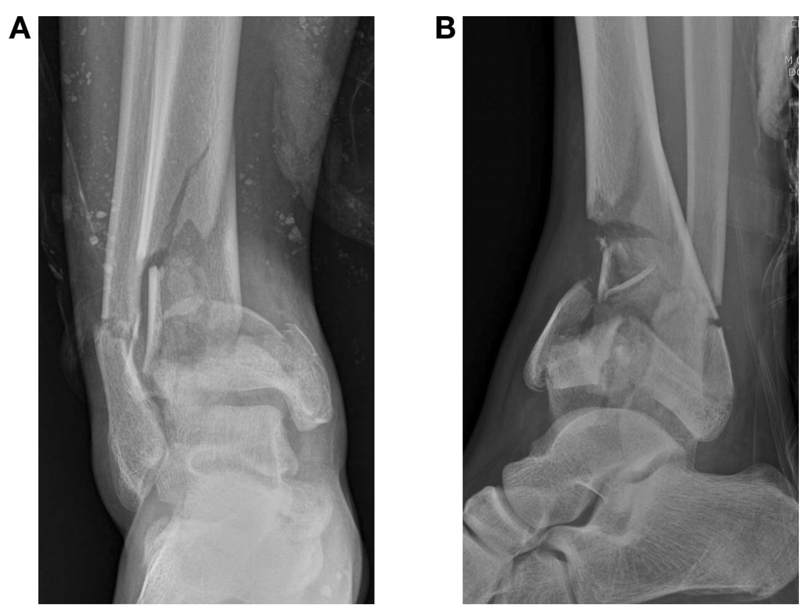 Surgical Treatment Approach for Pilon and Talar Dome Fracture. A Case ...
