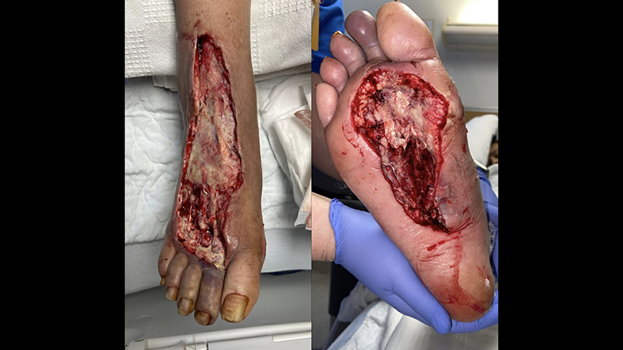 Assessment of Flap Viability for Complex Transmetatarsal Amputation ...