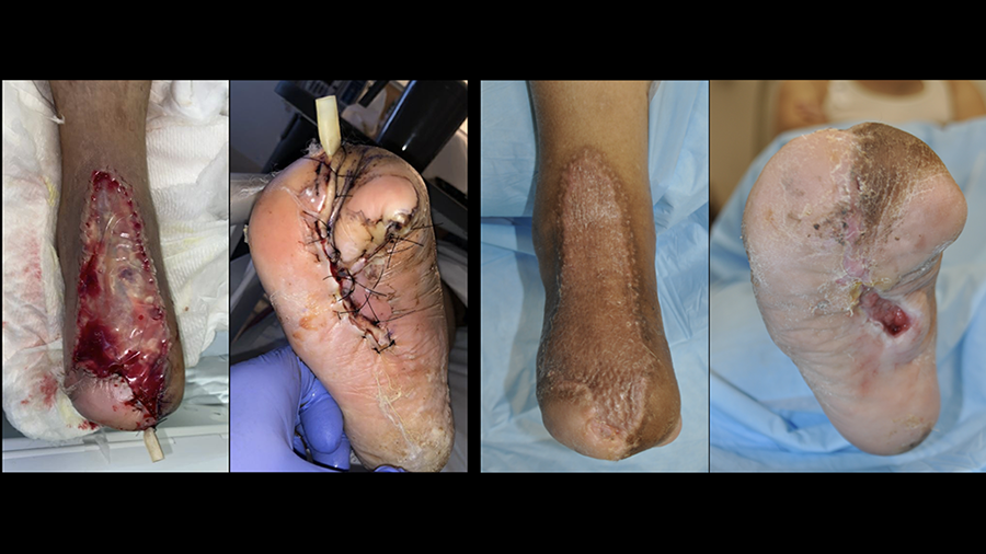 Assessment of Flap Viability for Complex Transmetatarsal Amputation ...