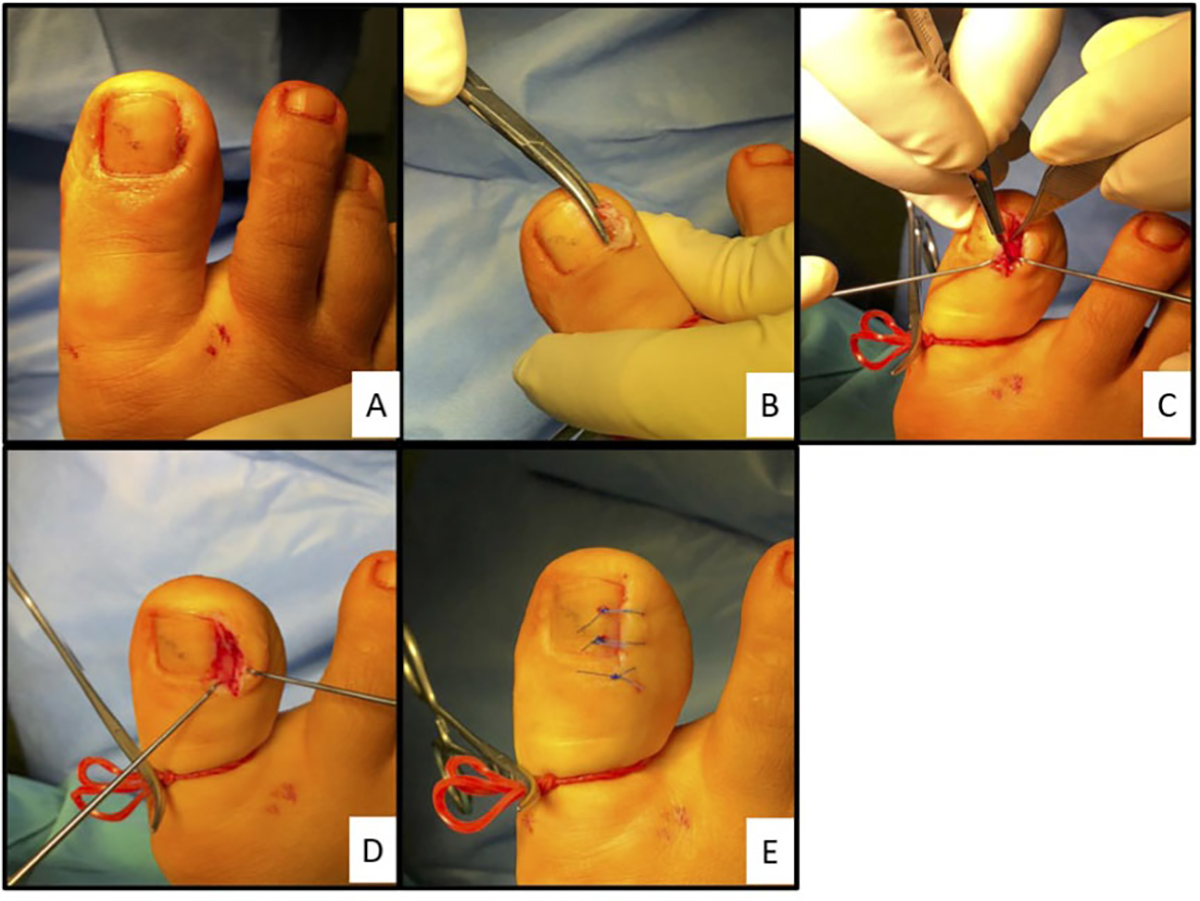 Winograd Wedge Resection Matrixectomy versus Partial Nail Avulsion with ...