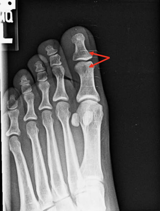 Atypical Presentation of Tenosynovial Giant Cell Tumor on the Hallucal ...