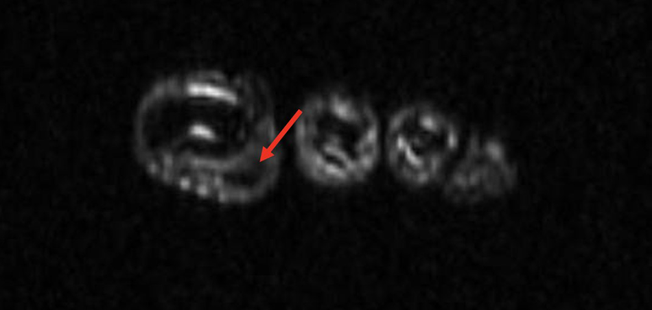 Atypical Presentation of Tenosynovial Giant Cell Tumor on the Hallucal ...