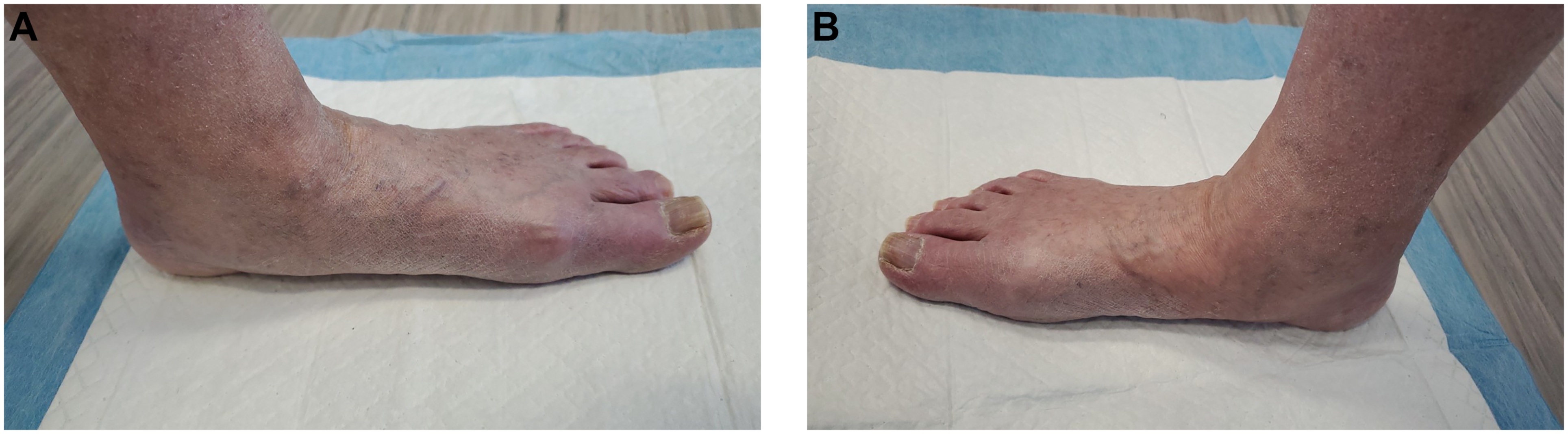 Müller-Weiss Disease Case Study Using Conservative Treatment