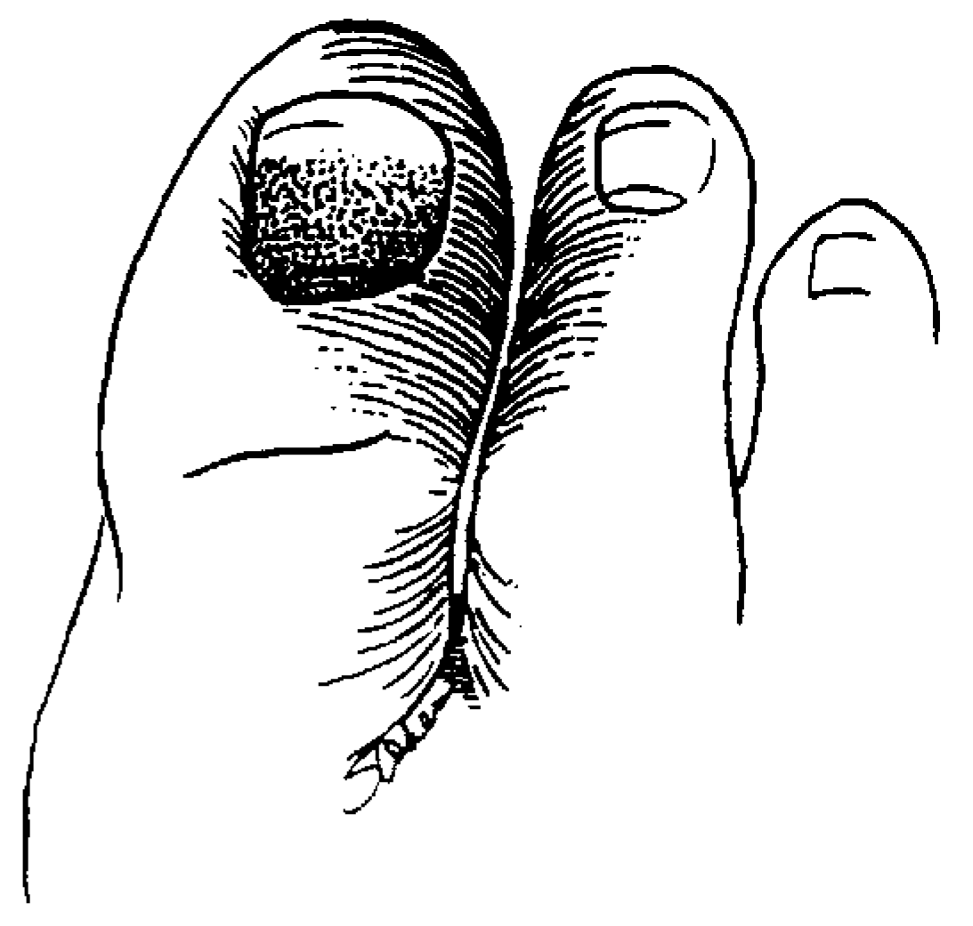 Nailbed Injuries with Hallucal Phalangeal Fractures. Evaluation and ...
