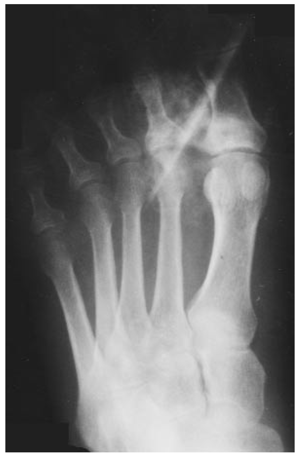 Treatment of stingray injury with topical becaplermin gel