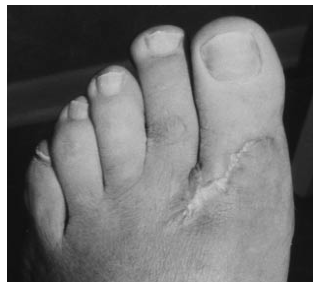 Treatment of stingray injury with topical becaplermin gel