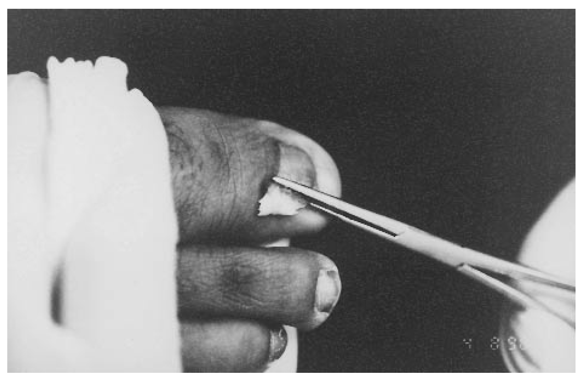 A Modified Approach to the Phenol and Alcohol Chemical Partial Matrixectomy