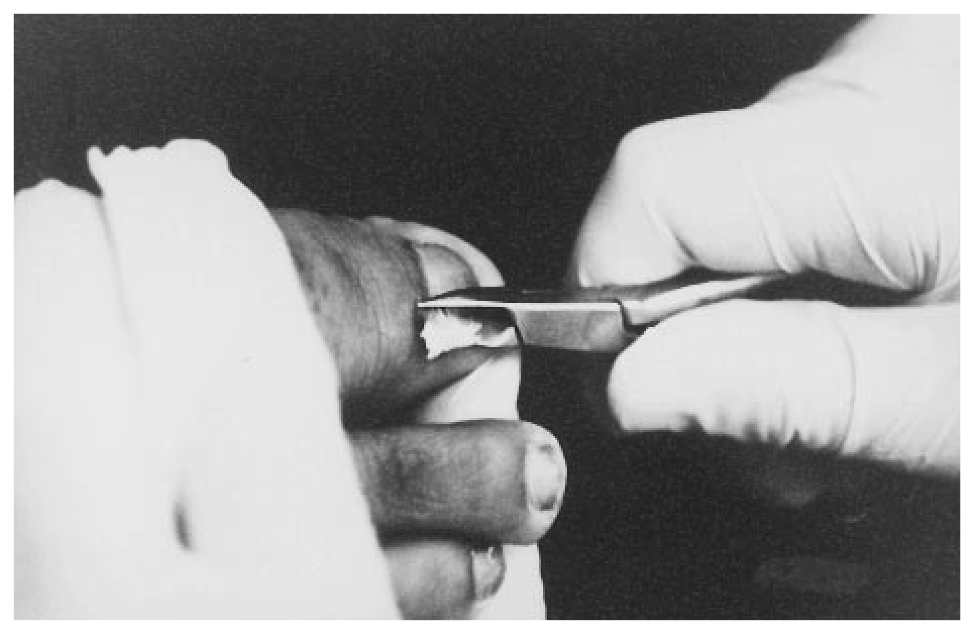 A Modified Approach to the Phenol and Alcohol Chemical Partial Matrixectomy