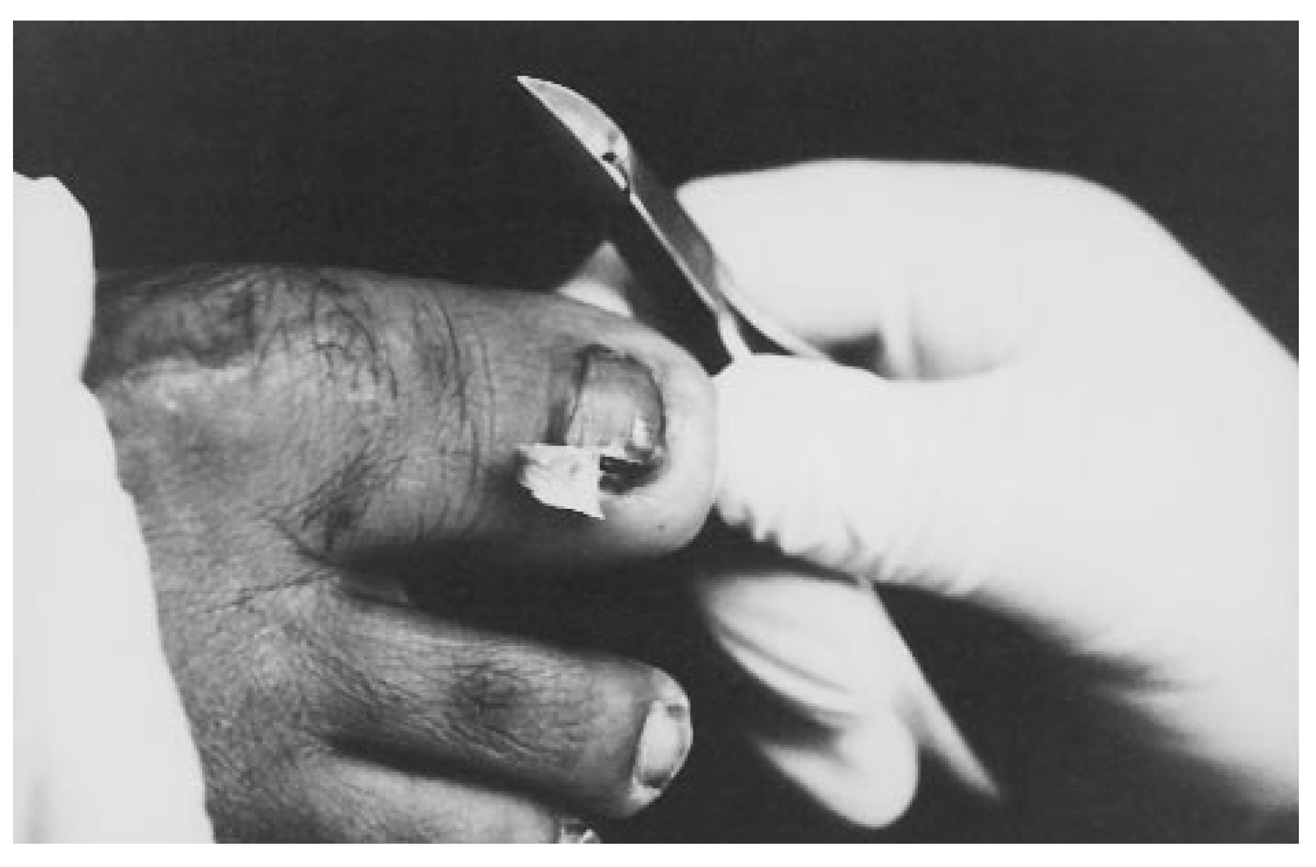 A Modified Approach to the Phenol and Alcohol Chemical Partial Matrixectomy