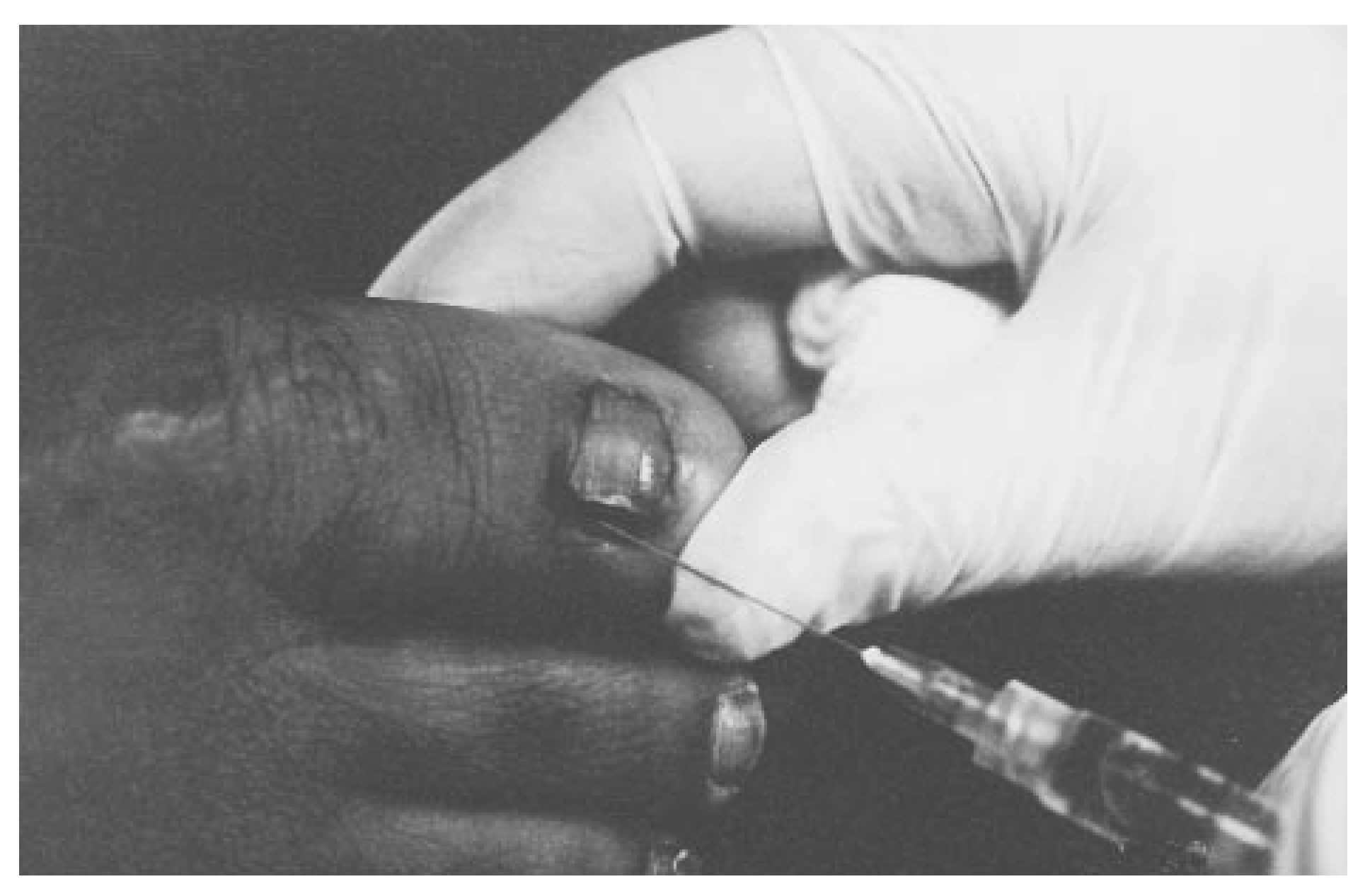 A Modified Approach to the Phenol and Alcohol Chemical Partial Matrixectomy