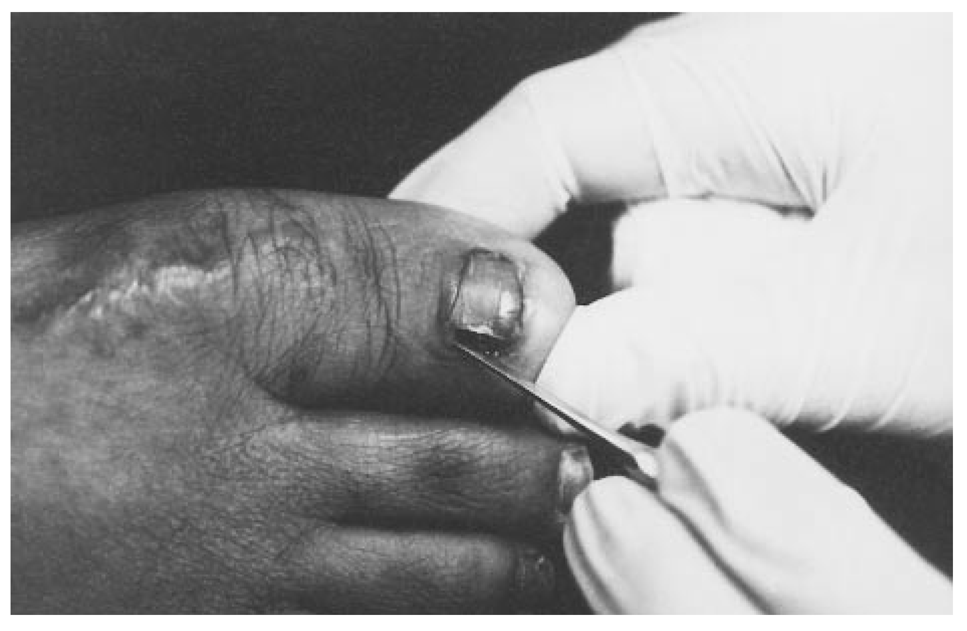 A Modified Approach to the Phenol and Alcohol Chemical Partial Matrixectomy