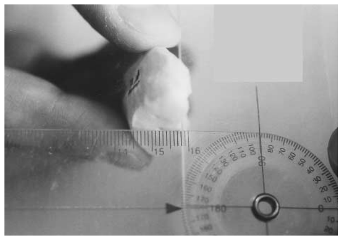 Is the Radiographic Appearance of the Hallucal Tarsometatarsal Joint ...