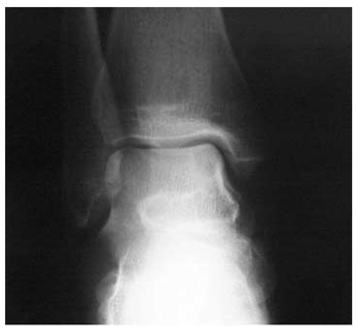 Arthroscopy-Assisted Retrograde Drilling of Osteochondral Lesions of ...
