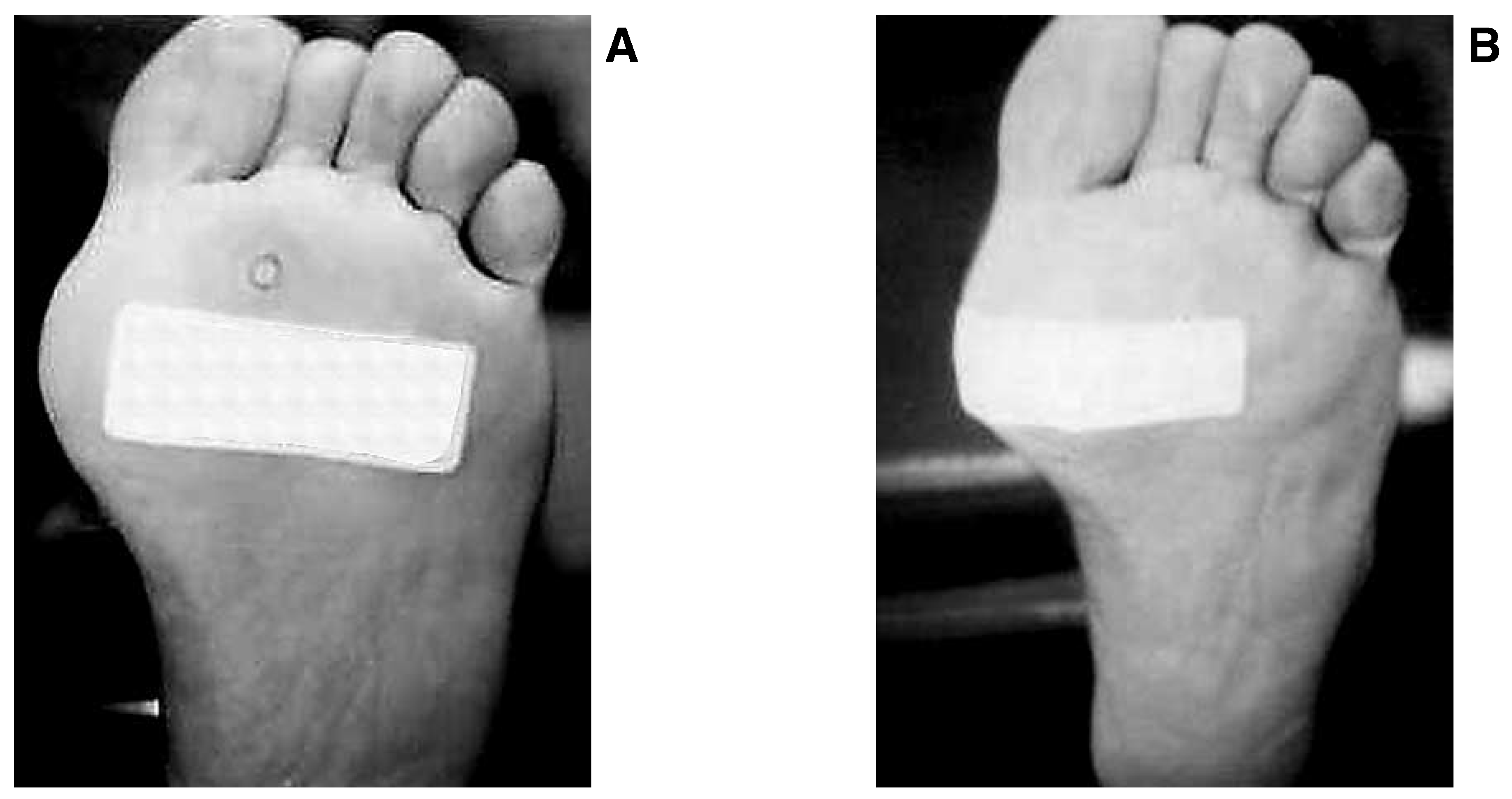 Treatment for Simple Plantar Verrucae. Monochloroacetic Acid and 10% ...