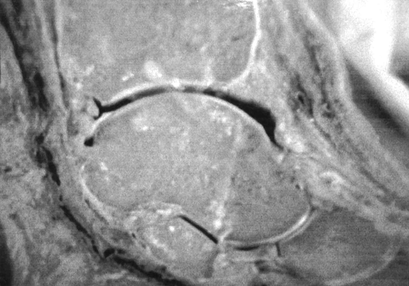 Arthroscopic Management of Talar Dome Lesions Using a Transmalleolar ...