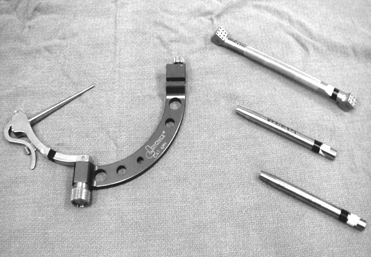 Arthroscopic Management of Talar Dome Lesions Using a Transmalleolar ...