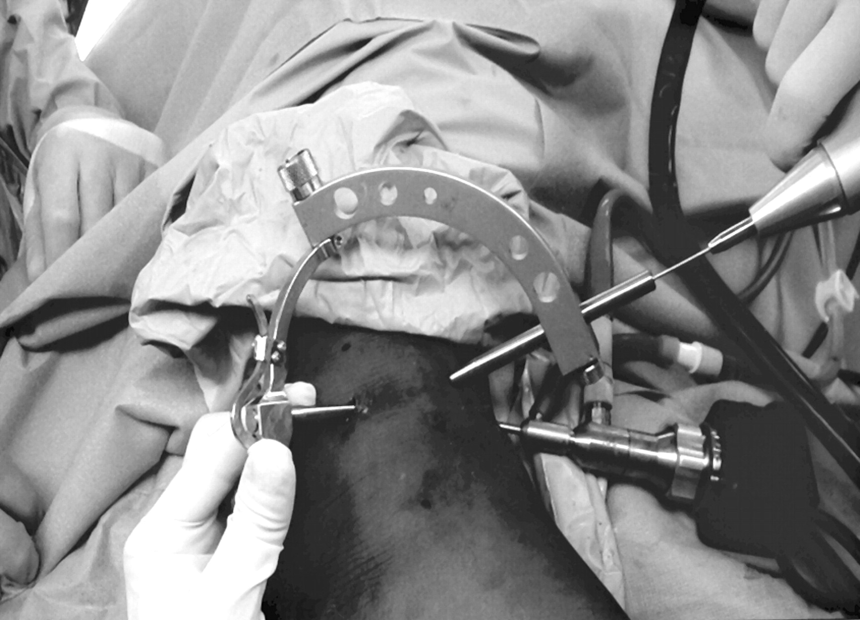 Arthroscopic Management of Talar Dome Lesions Using a Transmalleolar ...