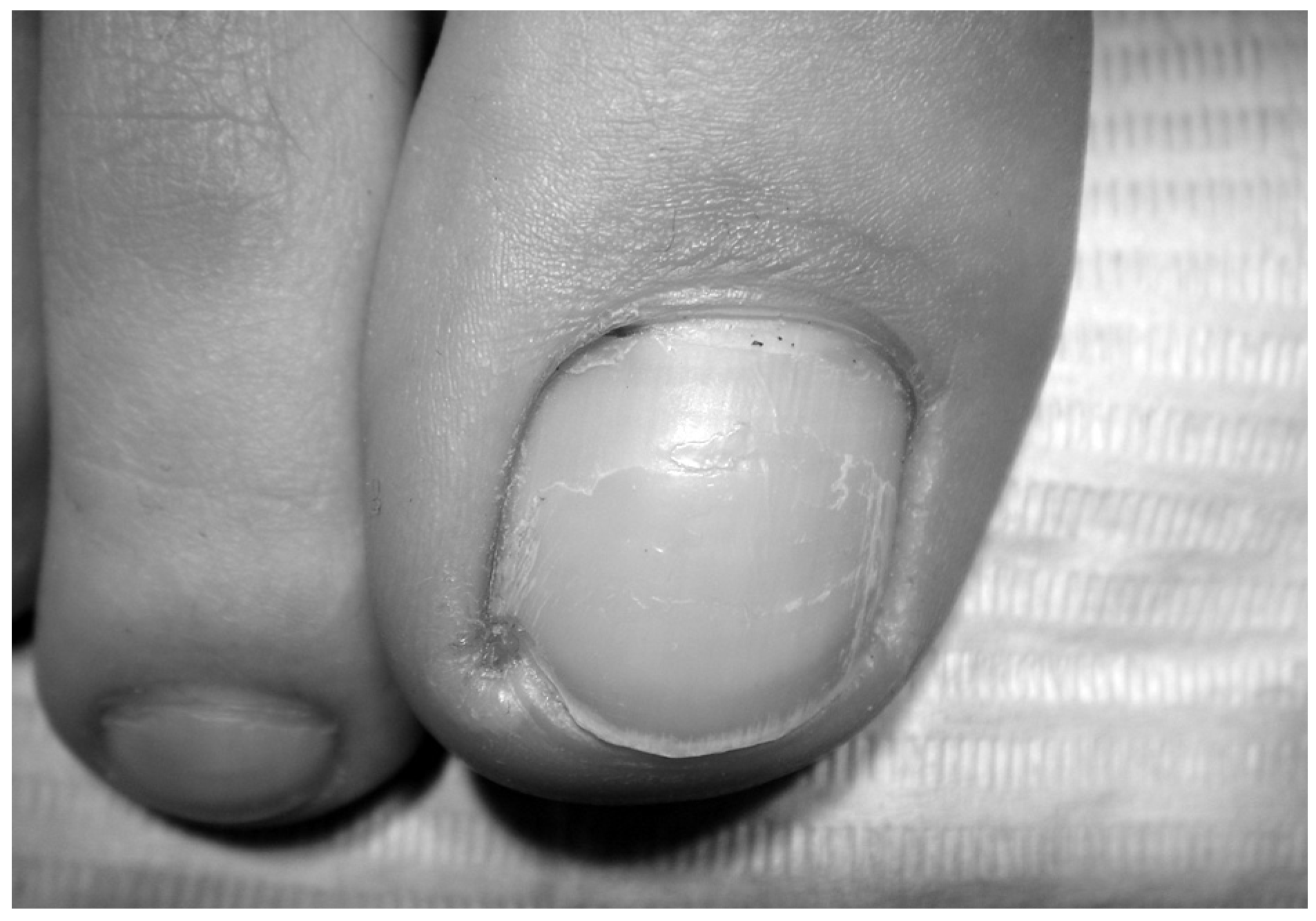 A New Onychocryptosis Classification and Treatment Plan