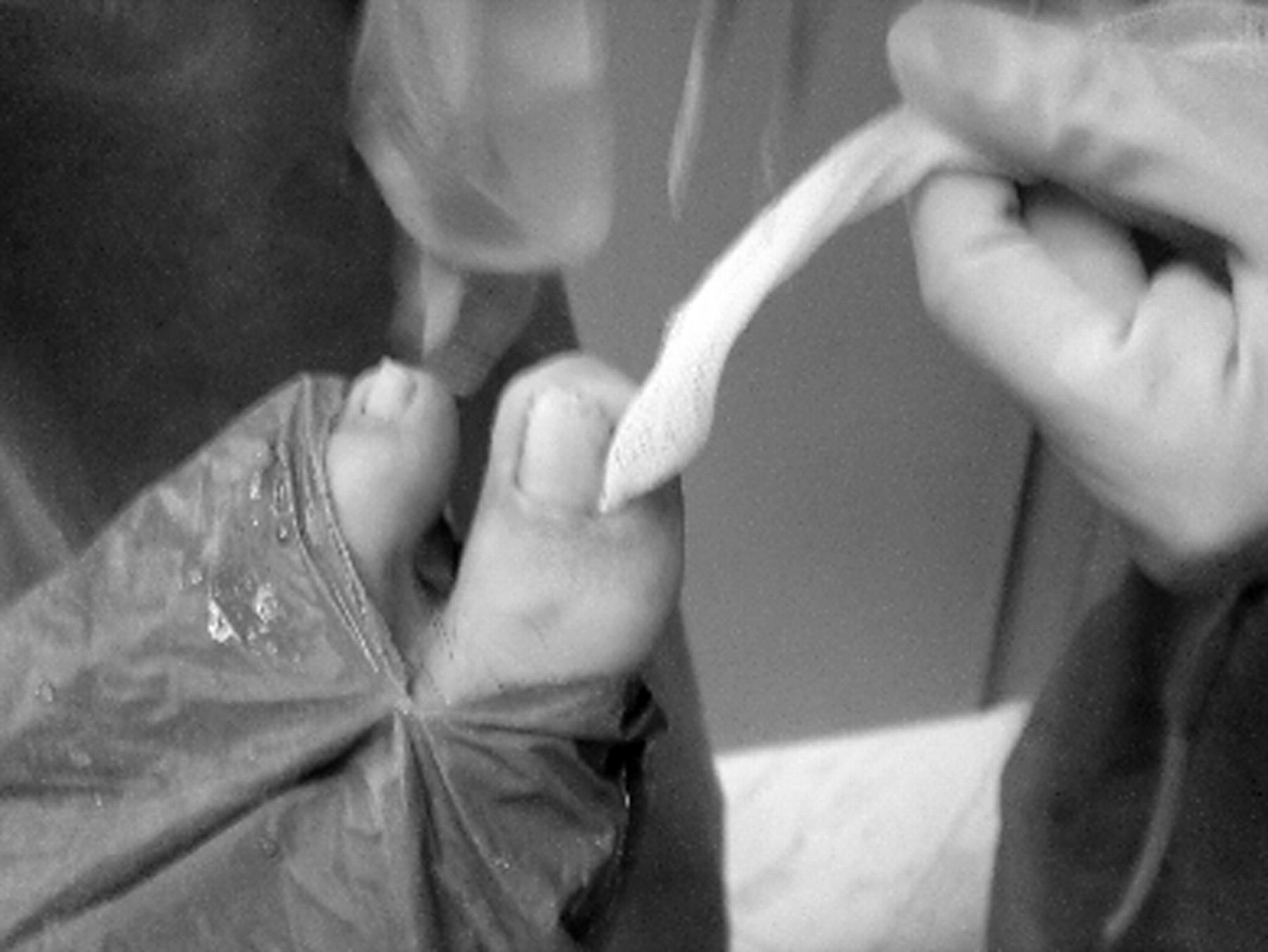 Gauze Application of Phenol for Matrixectomy