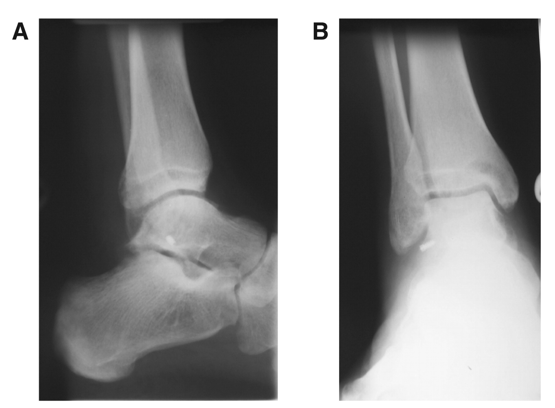 Talar Anchor Placement for Modified Brostrom Lateral Ankle ...