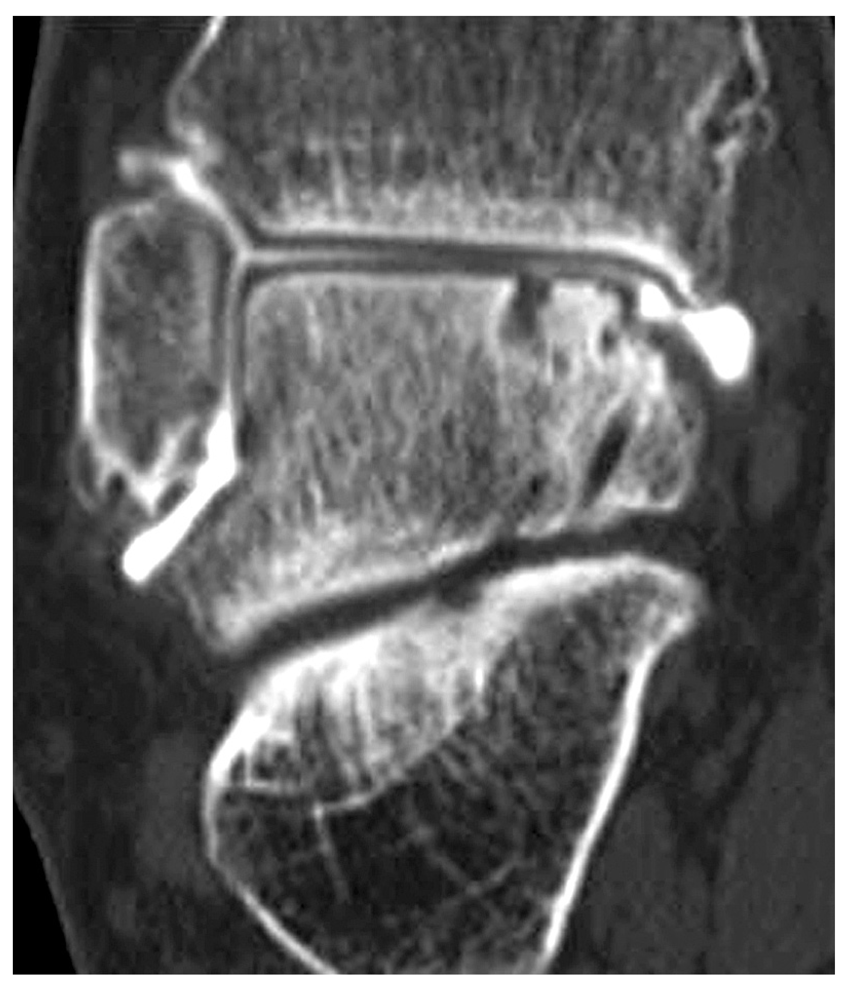 Iatrogenic Osteochondral Kissing Lesion After Transmalleolar Drilling ...