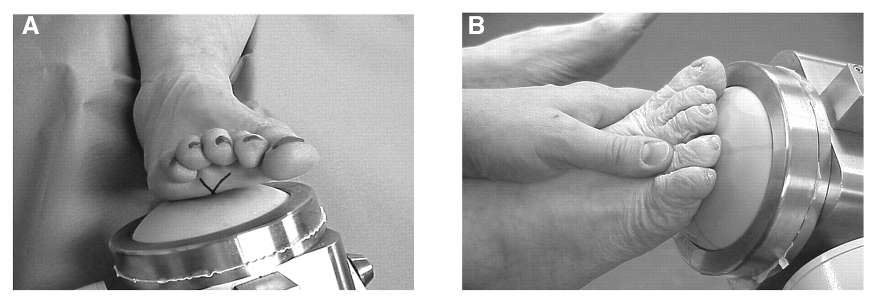 Extracorporeal Shockwave Therapy for Interdigital Neuroma. A Randomized ...