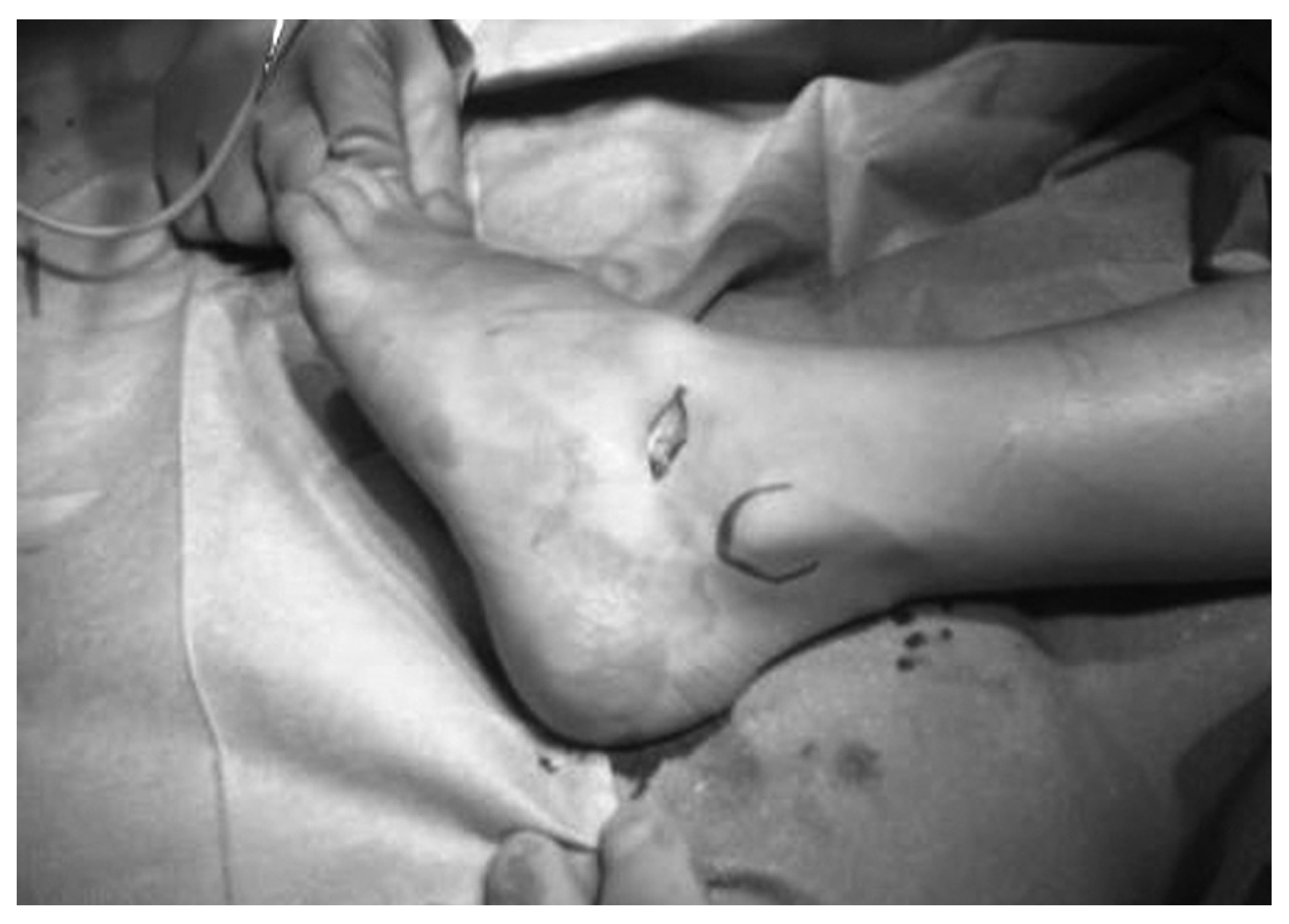 Subtalar Arthroereisis for Pediatric Flexible Pes Planovalgus. Fifteen ...