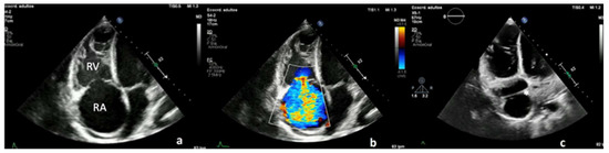 An Unusual Cause of Right Heart Dysfunction and High Output Heart ...