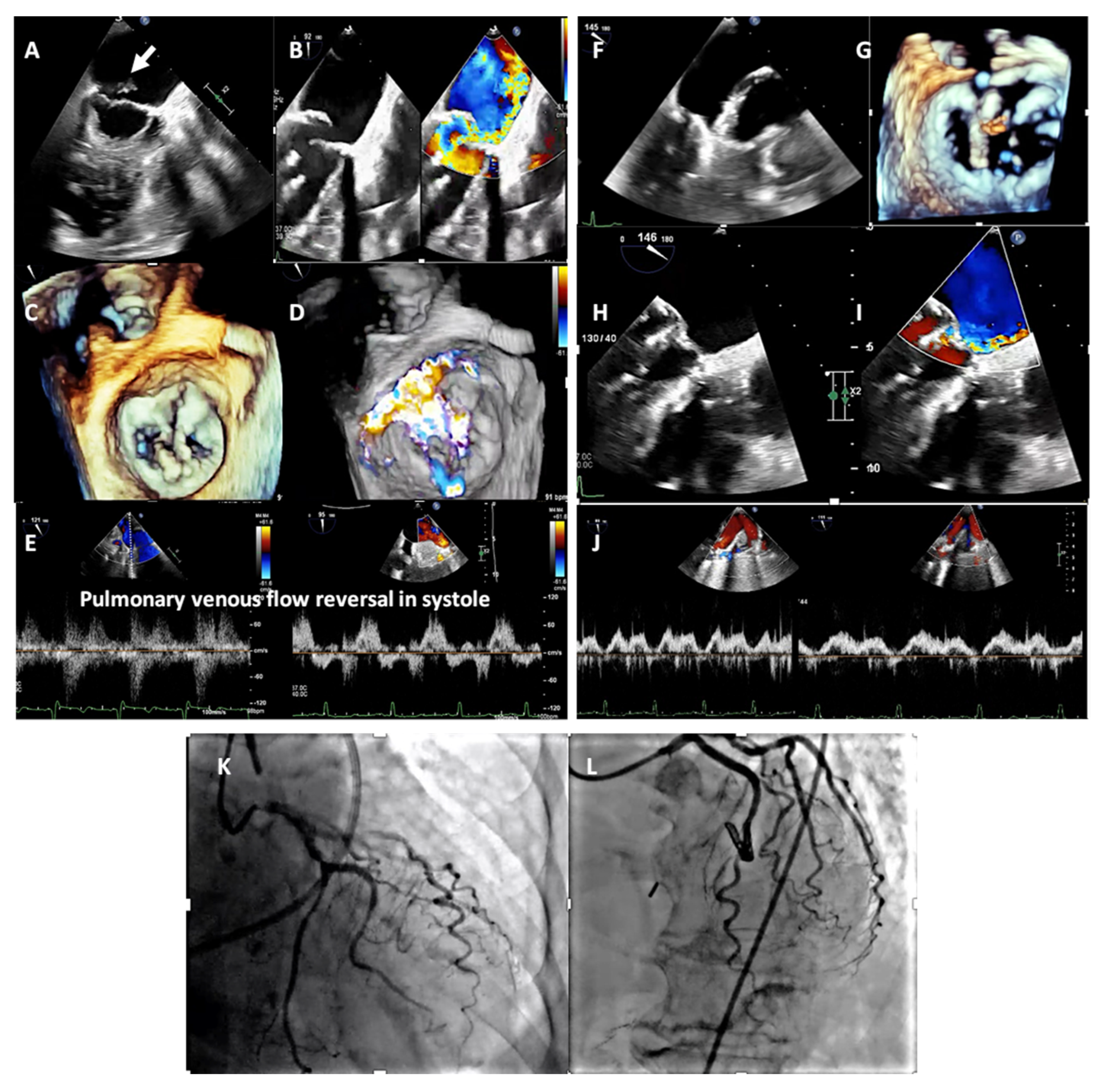 Transcatheter Edge-to-Edge Mitral Valve Repair for Severe Regurgitation ...