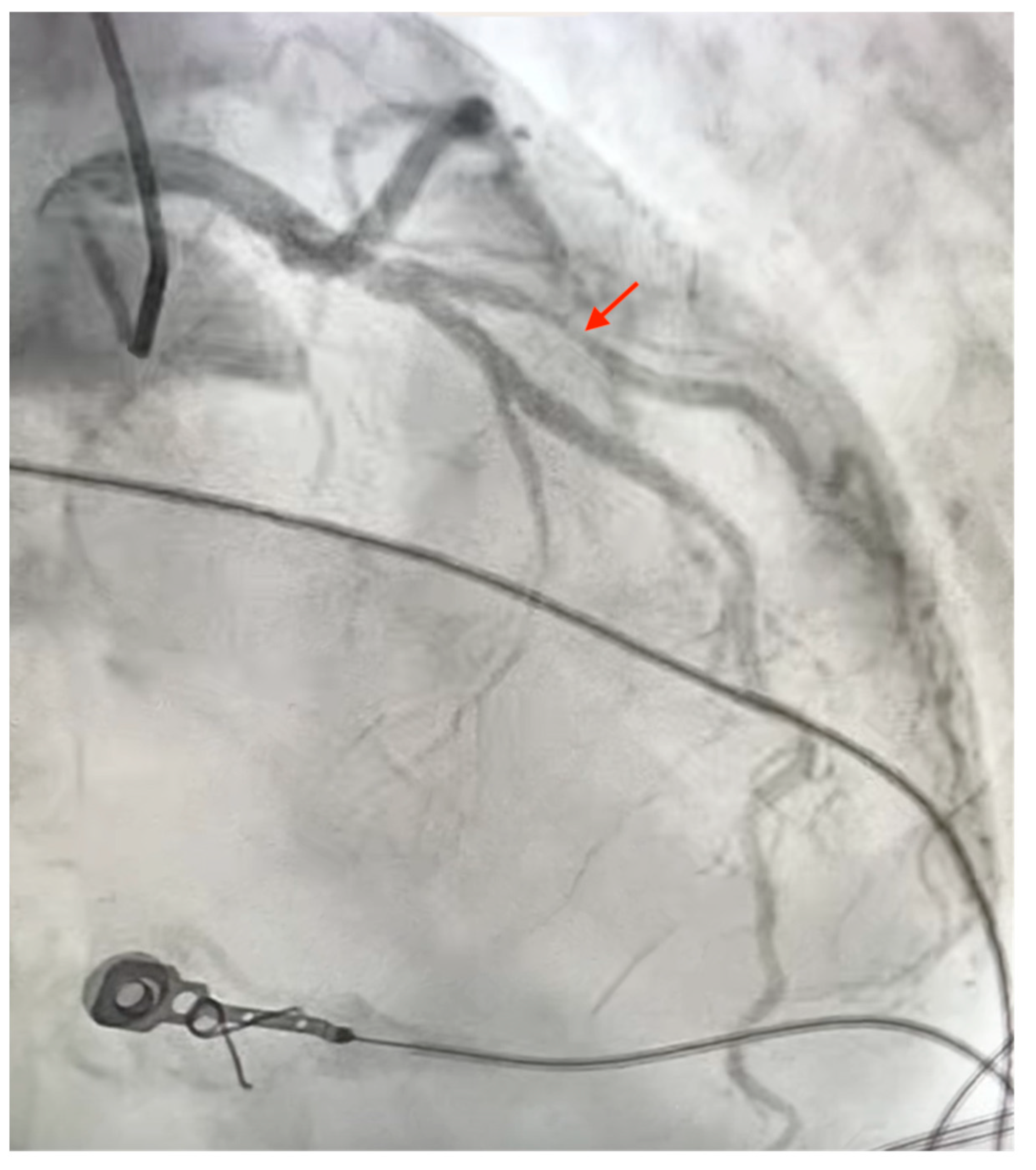 Orthotopic Heart Transplantation with Concurrent Coronary Artery Bypass ...