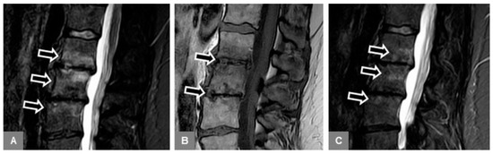 JCM | Free Full-Text | Vertebral Bone Marrow and Endplate Assessment on ...