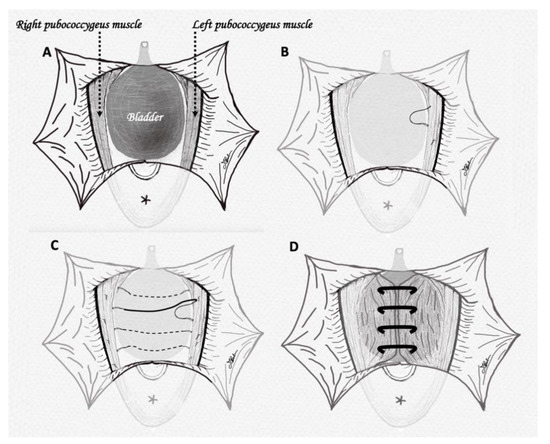 Cystocele Repair by a Modified Surgical Technique of Bilateral ...
