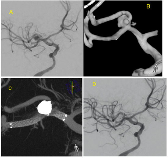 Initial Experience with LVIS EVO Stents for the Treatment of Intracranial Aneurysms