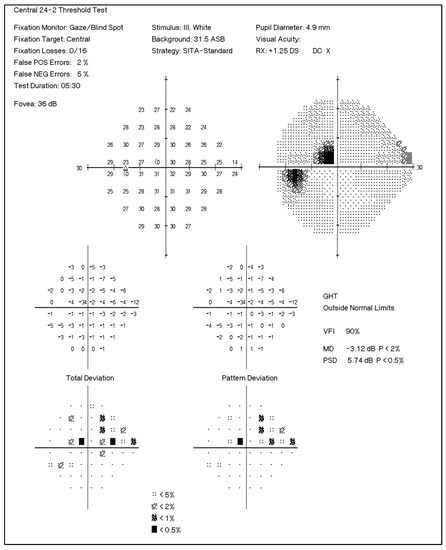 Aqueous Humor Proteomic Alterations Associated with Visual Field Index ...