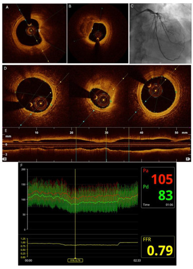 OCT-Derived Plaque Morphology and FFR-Determined Hemodynamic Relevance ...
