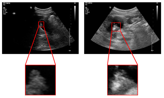 Gallbladder Polyp Classification in Ultrasound Images Using an Ensemble ...