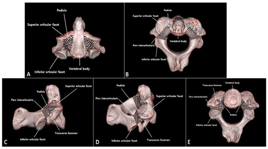 Proposal of Treatment Strategy for Pedicle Fractures of the C2: An ...