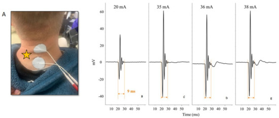 Invasive and Non-Invasive Approaches of Electrical Stimulation to ...