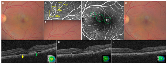 Factors Predicting Response to Selective Retina Therapy in Patients ...