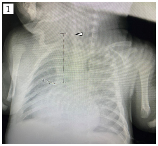 Ideal Depth of Endotracheal Intubation at the Vocal Cord Level in ...