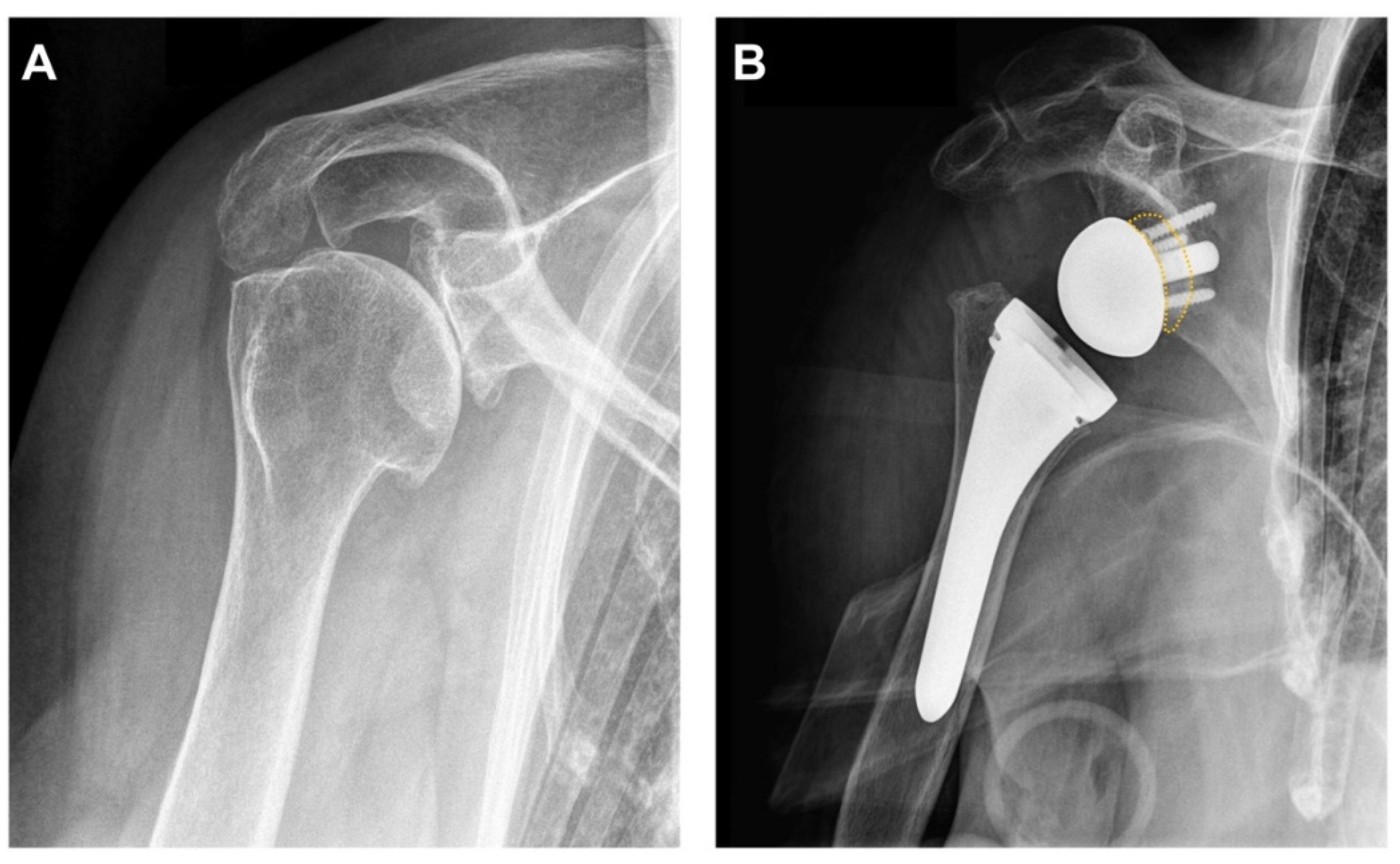 JCM Free Full Text The Evolution Of Reverse Total Shoulder JCM Free Full Text The Evolution Of Reverse Total Shoulder