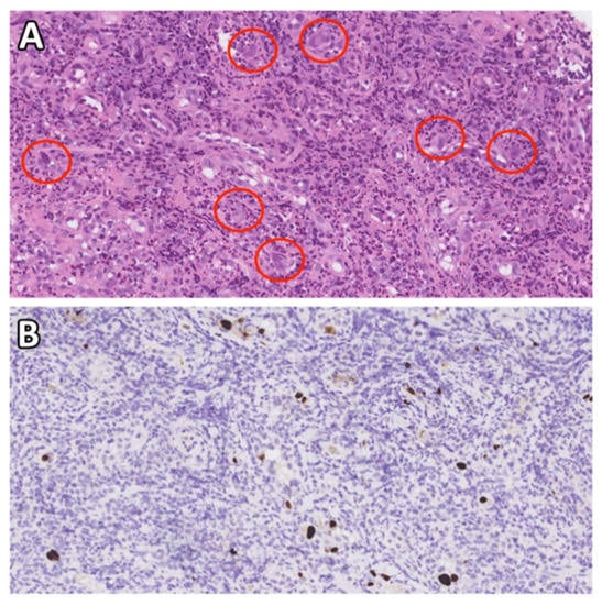 Risk Factors, Clinical and Endoscopic Features, and Clinical Outcomes ...