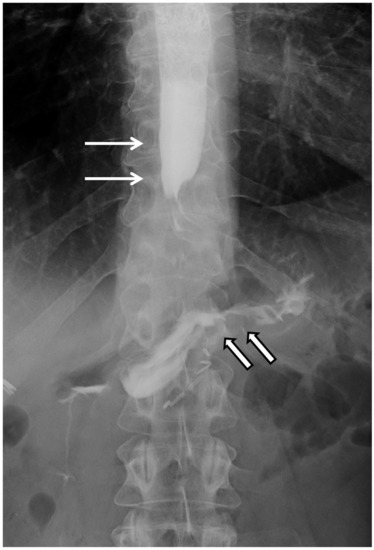 Twisted Gastric Tube after Laparoscopic Sleeve Gastrectomy—An Unusual ...