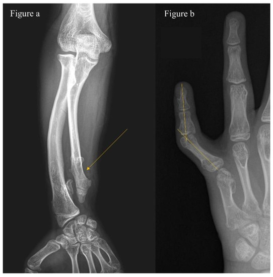 A Genotype-Phenotype Study of Multiple Hereditary Exostoses in Forty ...
